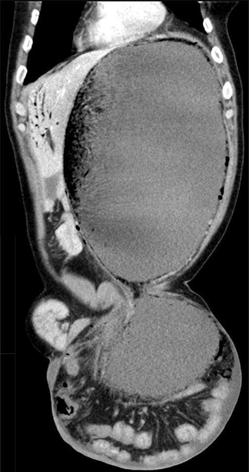 Gastric Necrosis Secondary to Inguinal Incarceration | Cirugía Española ...
