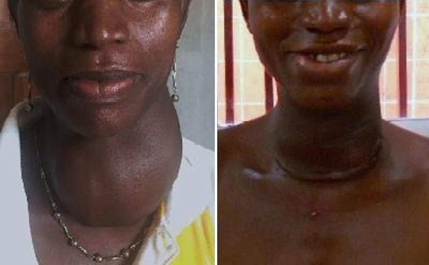Thyroid Surgery at a Volunteer Program in Sub-Saharan Africa | Cirugía ...
