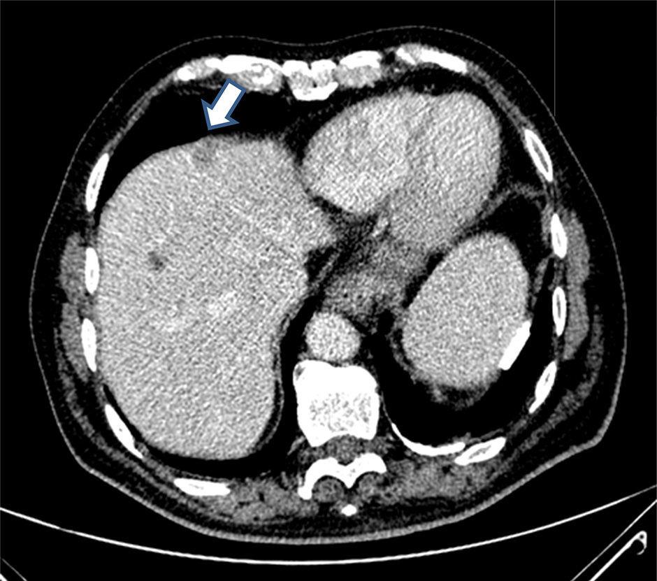 Ciliated Hepatic Foregut Cysts: A Differential Diagnosis in Hepatic ...