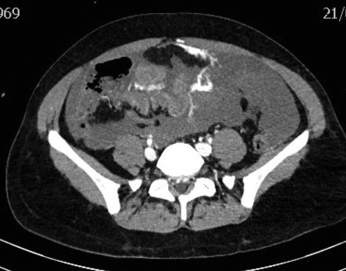 Massive Hemoperitoneum due to a Ruptured Umbilical Vein in a Cirrhotic ...