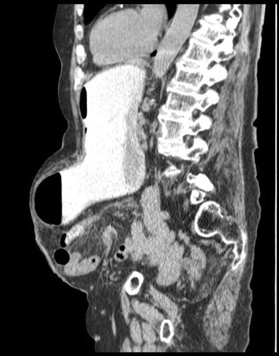 Gastric Incarceration in a Peristomal Hernia | Cirugía Española ...