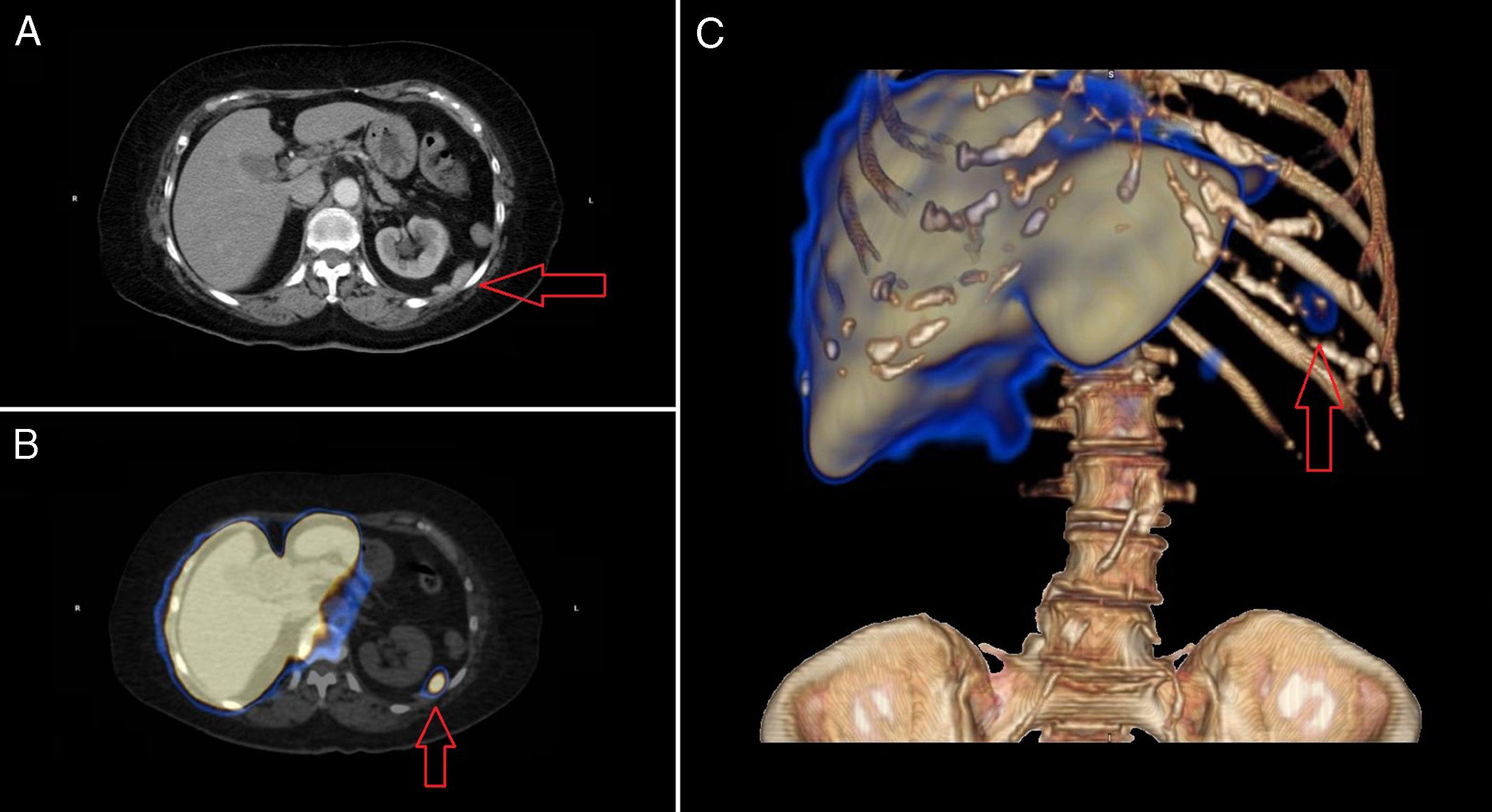 Abdominal Splenosis: Usefulness of 99mTc-phytate Hepato-splenic ...