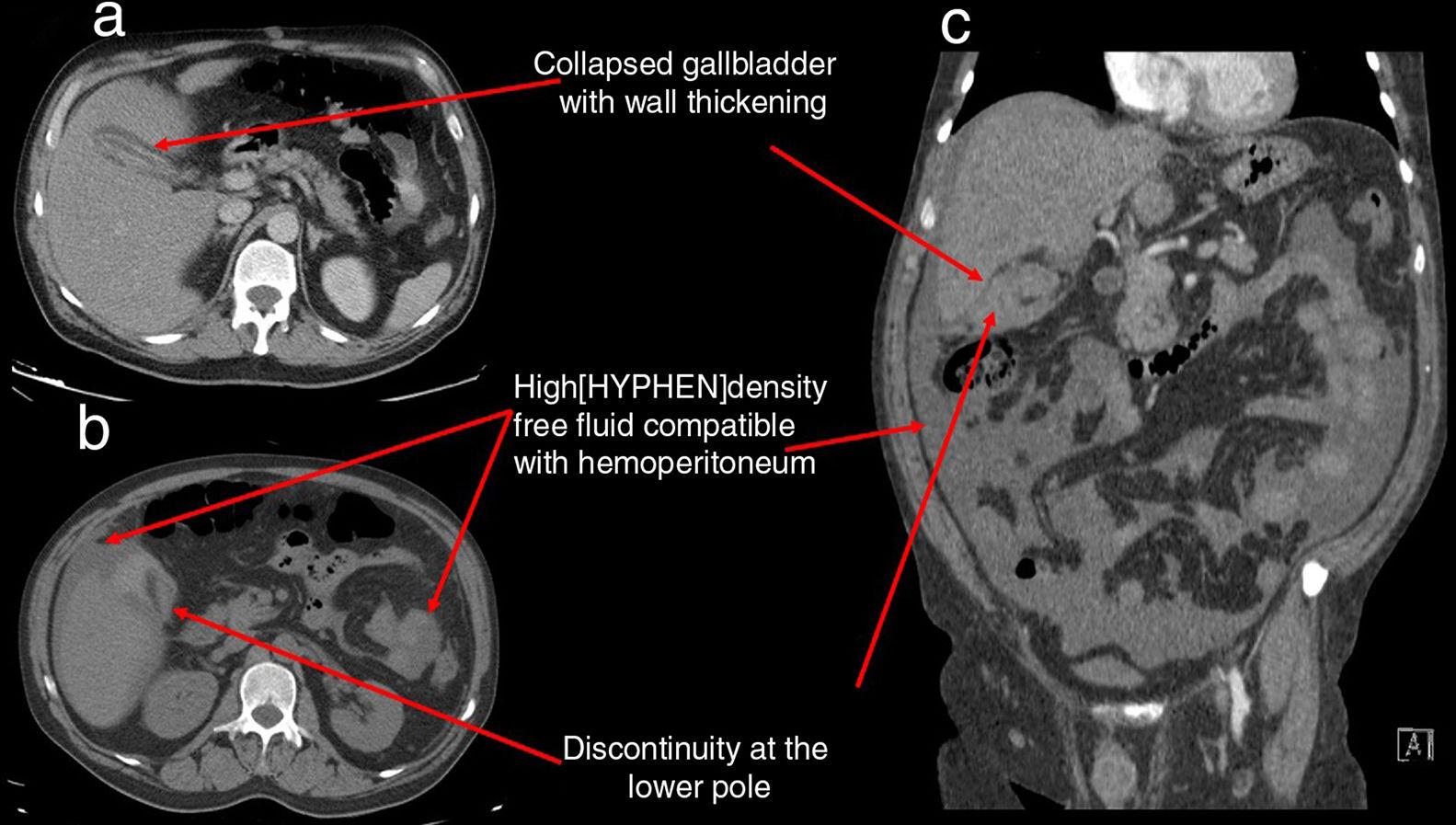Hemoperitoneum Due to Delayed Gallbladder Rupture After Abdominal ...