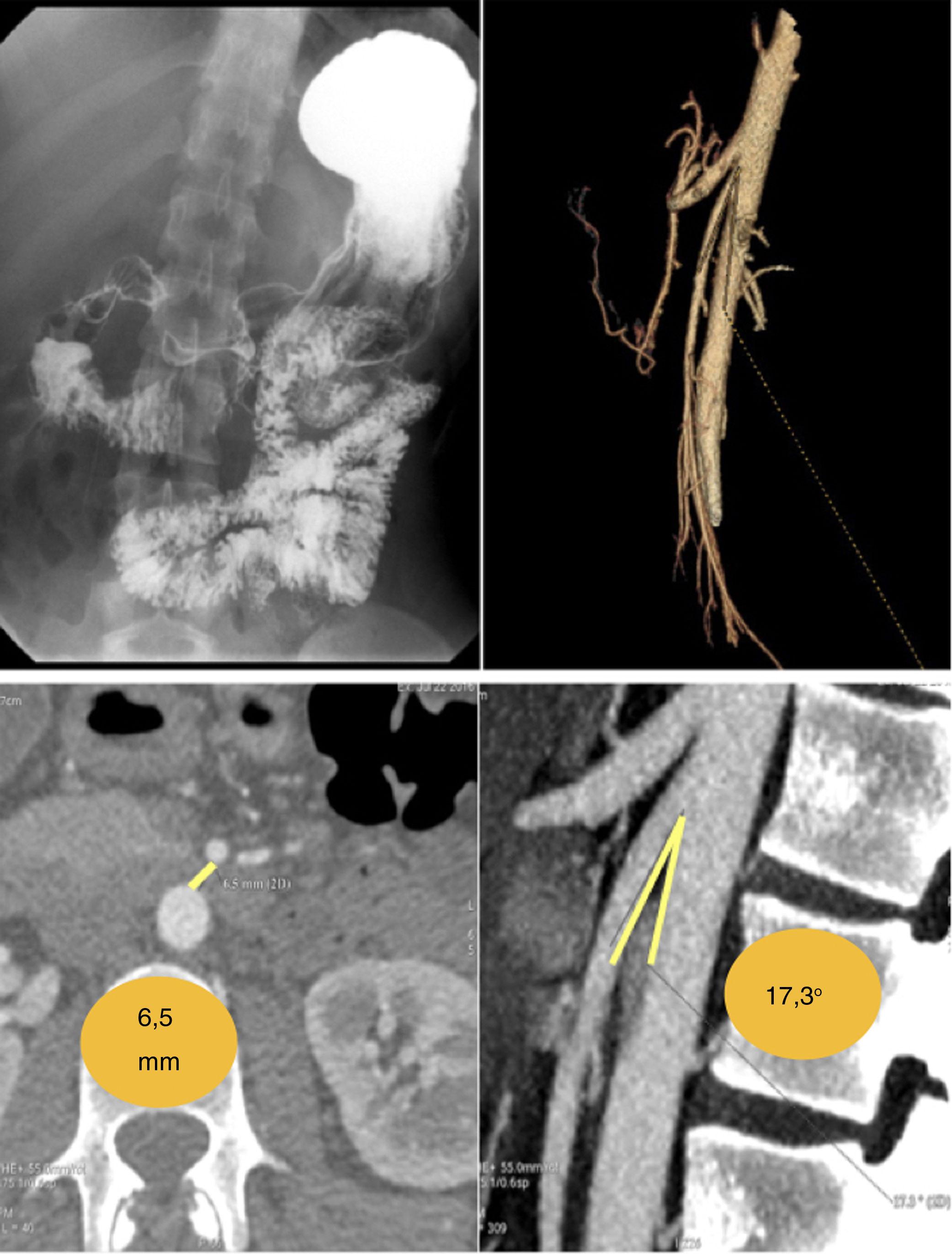 Superior Mesenteric Artery Syndrome (Wilkie Syndrome): Analysis of a ...