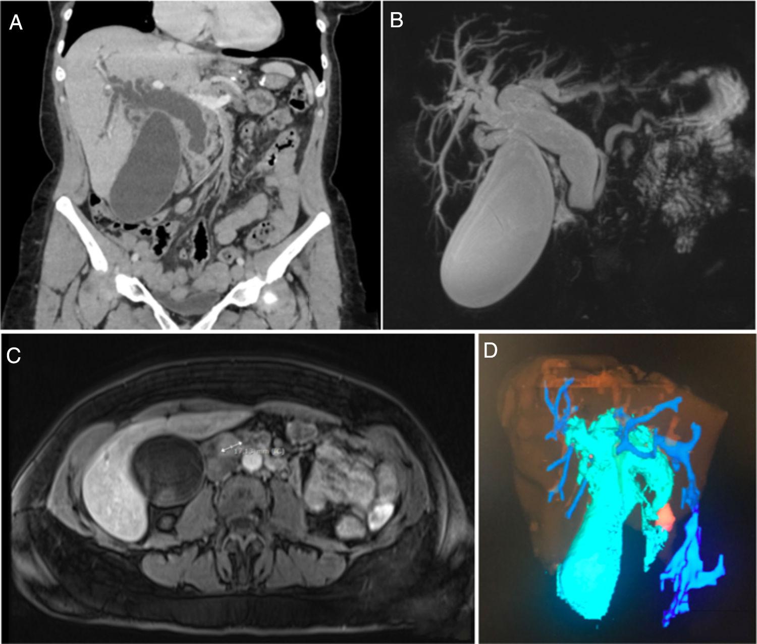 Ampulloma in a patient with a history of Roux-en-Y gastrojejunal bypass ...