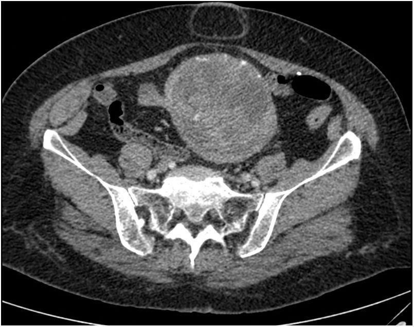 Incidental finding of abdominal textiloma simulating GIST tumor ...