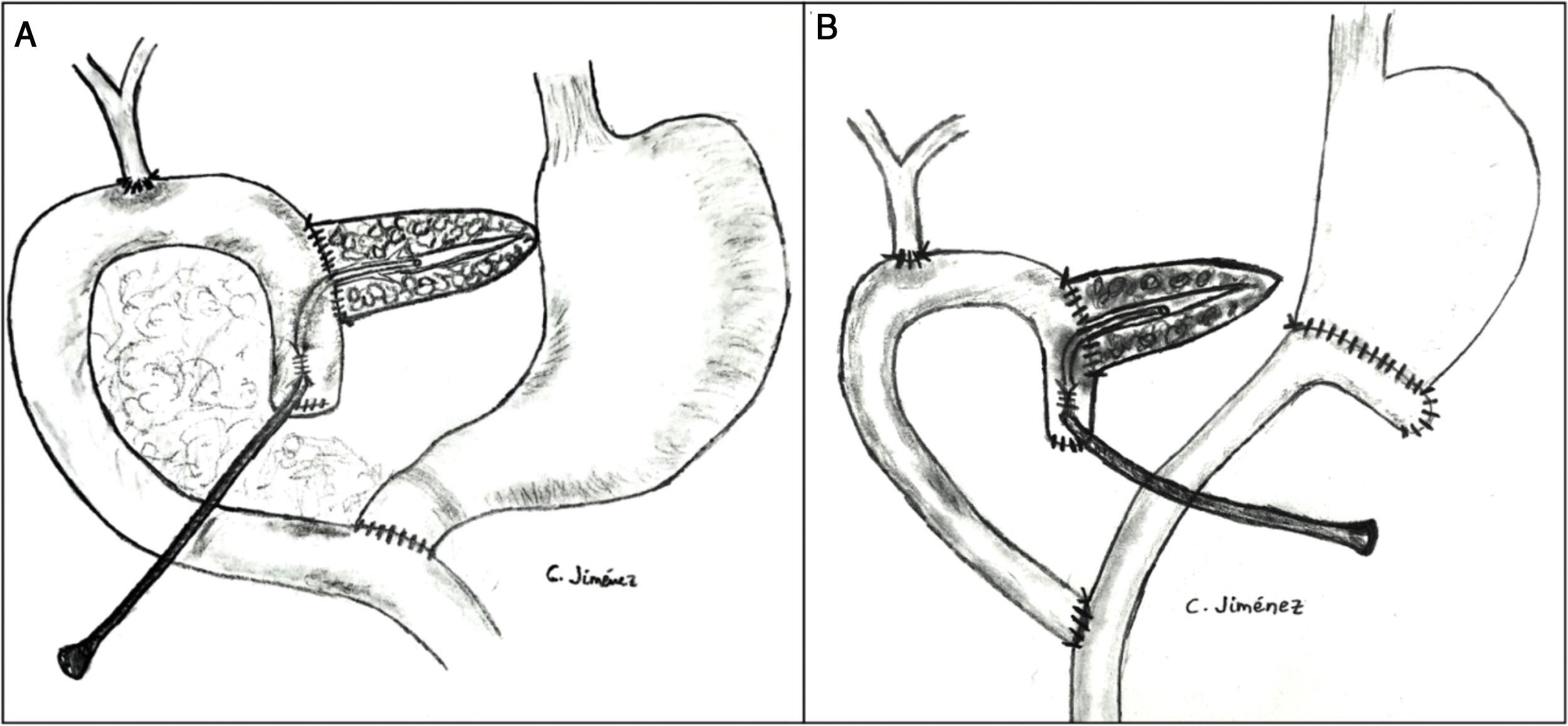 Pancreaticoduodenectomy and external Wirsung stenting: Our outcomes in ...