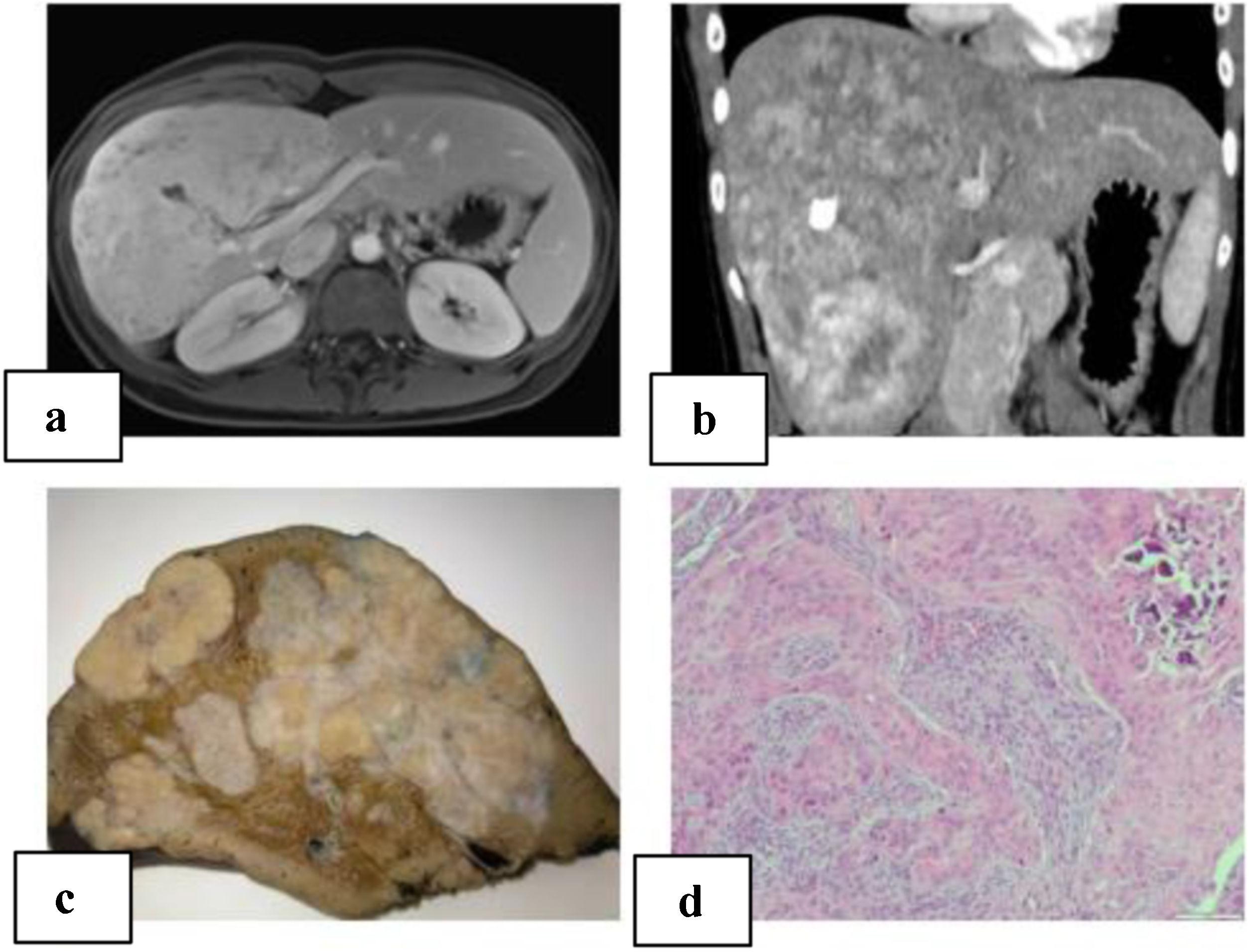 Calcifying nested stromal-epithelial tumor: A rare hepatic neoplasm ...