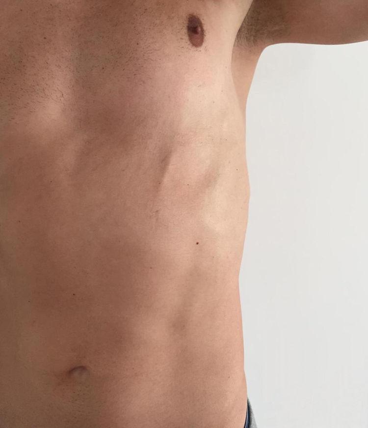 Mondor disease in male: An infrecuent clinical entity | Cirugía ...