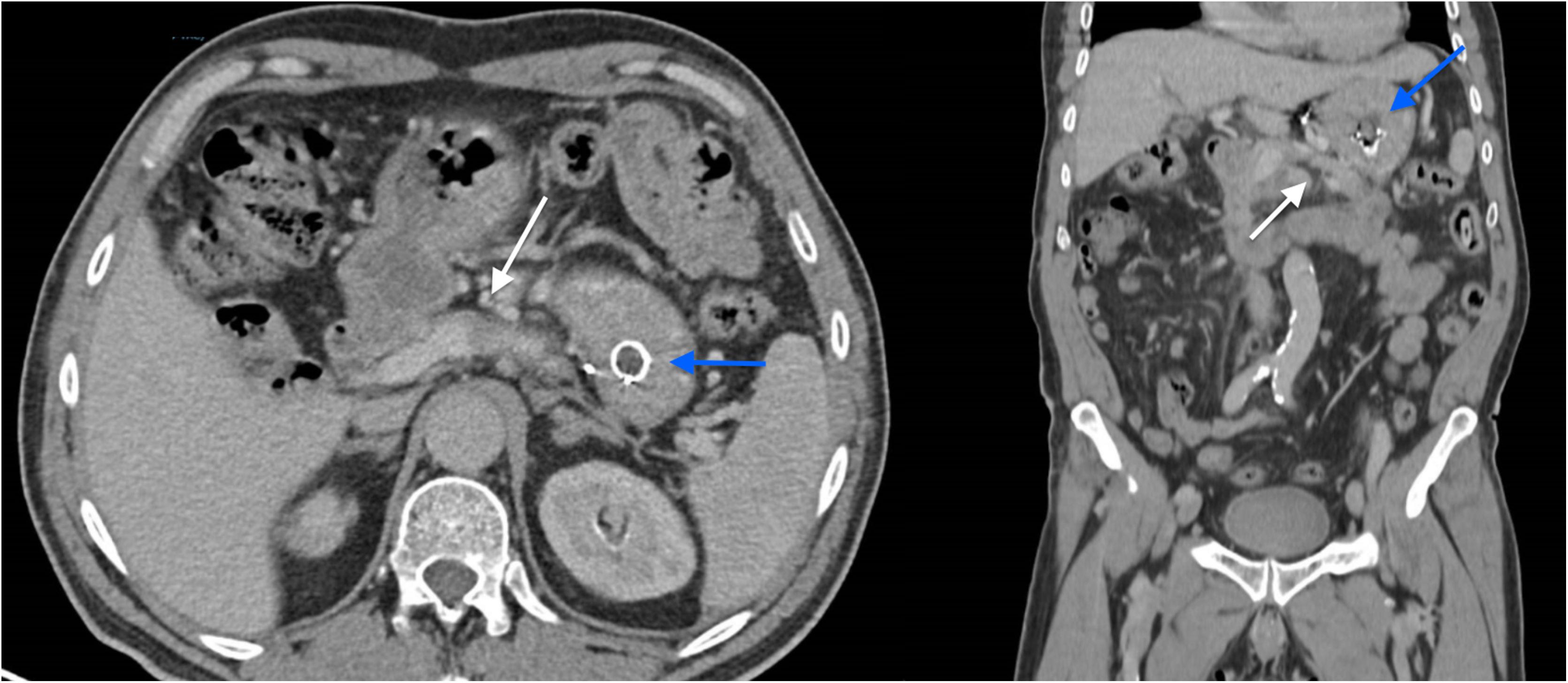 Step-up approach in severe necrotizing pancreatitis: Combination of ...