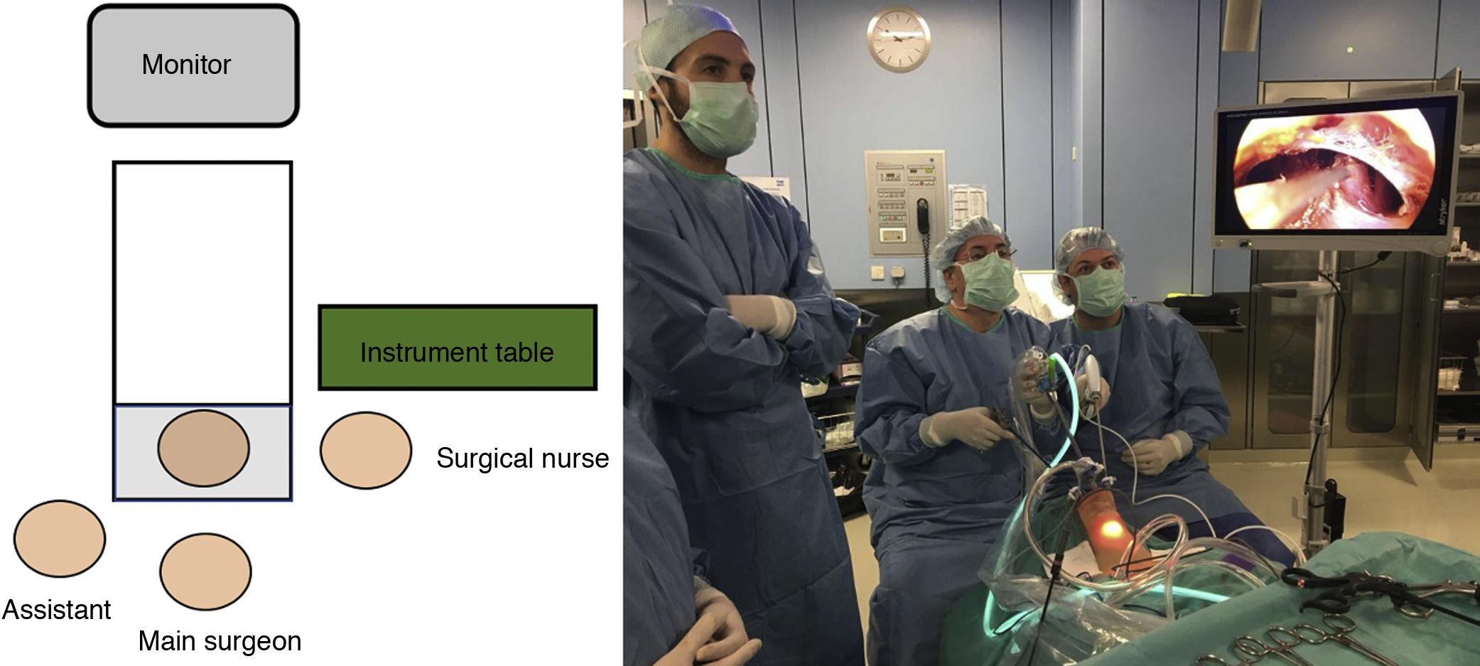 Transoral endoscopic thyroidectomy vestibular approach (TOETVA ...