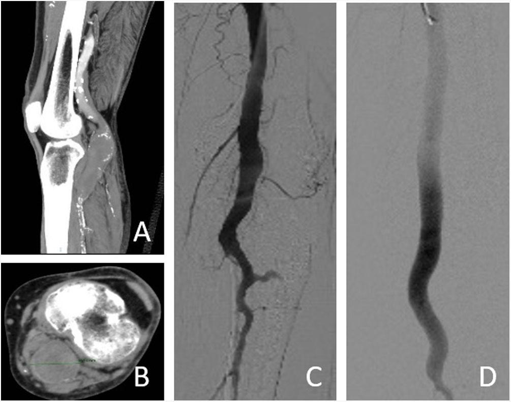 Endovascular treatment of popliteal artery aneurysm in high-risk ...