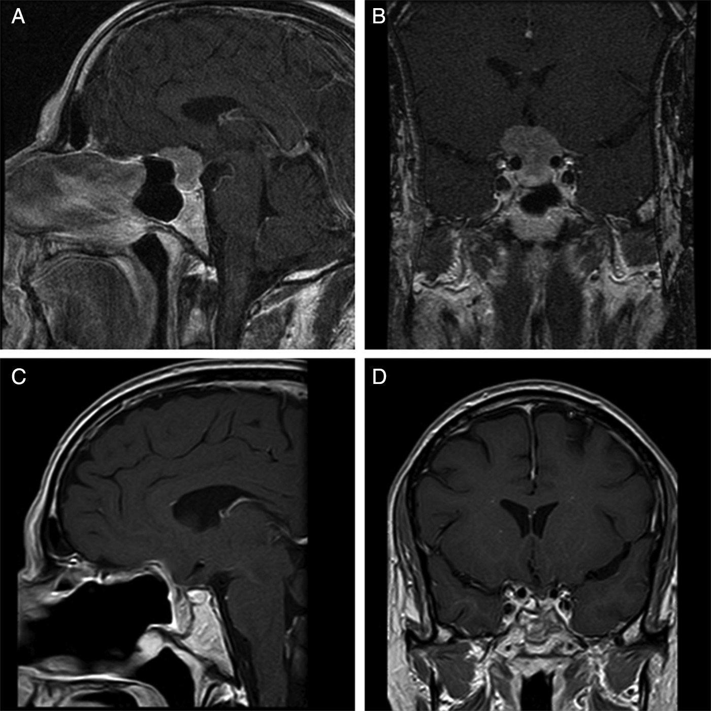 Tuberculum Sellae Meningioma