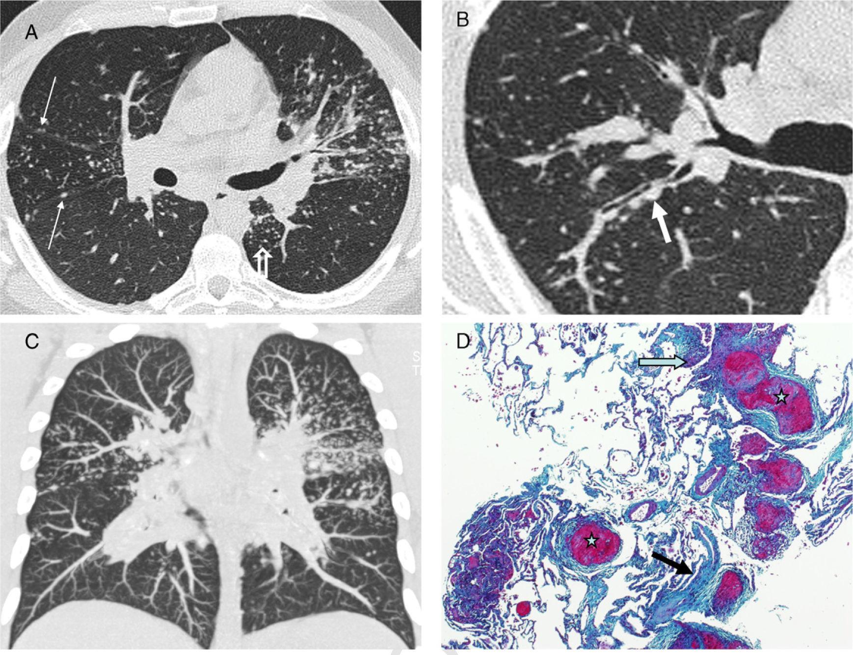 Update thoracic sarcoidosis | Radiología (English Edition)