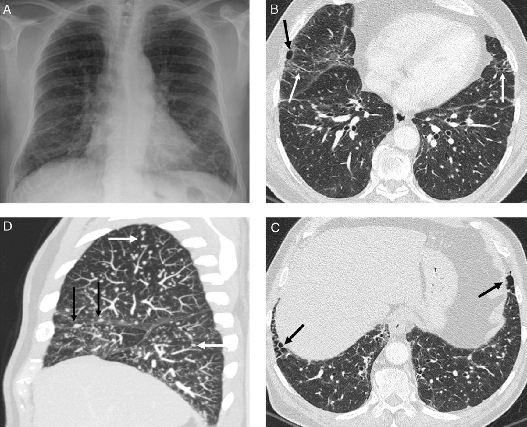 Update thoracic sarcoidosis | Radiología (English Edition)