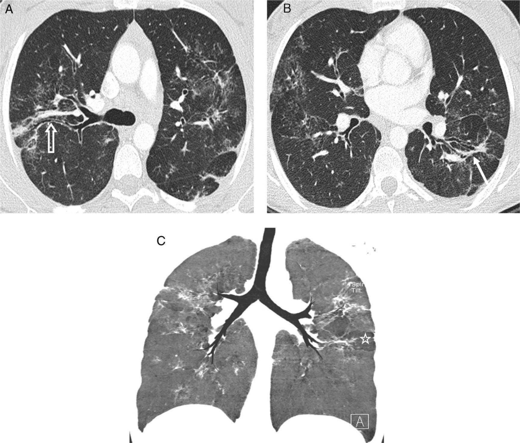 Update thoracic sarcoidosis | Radiología (English Edition)