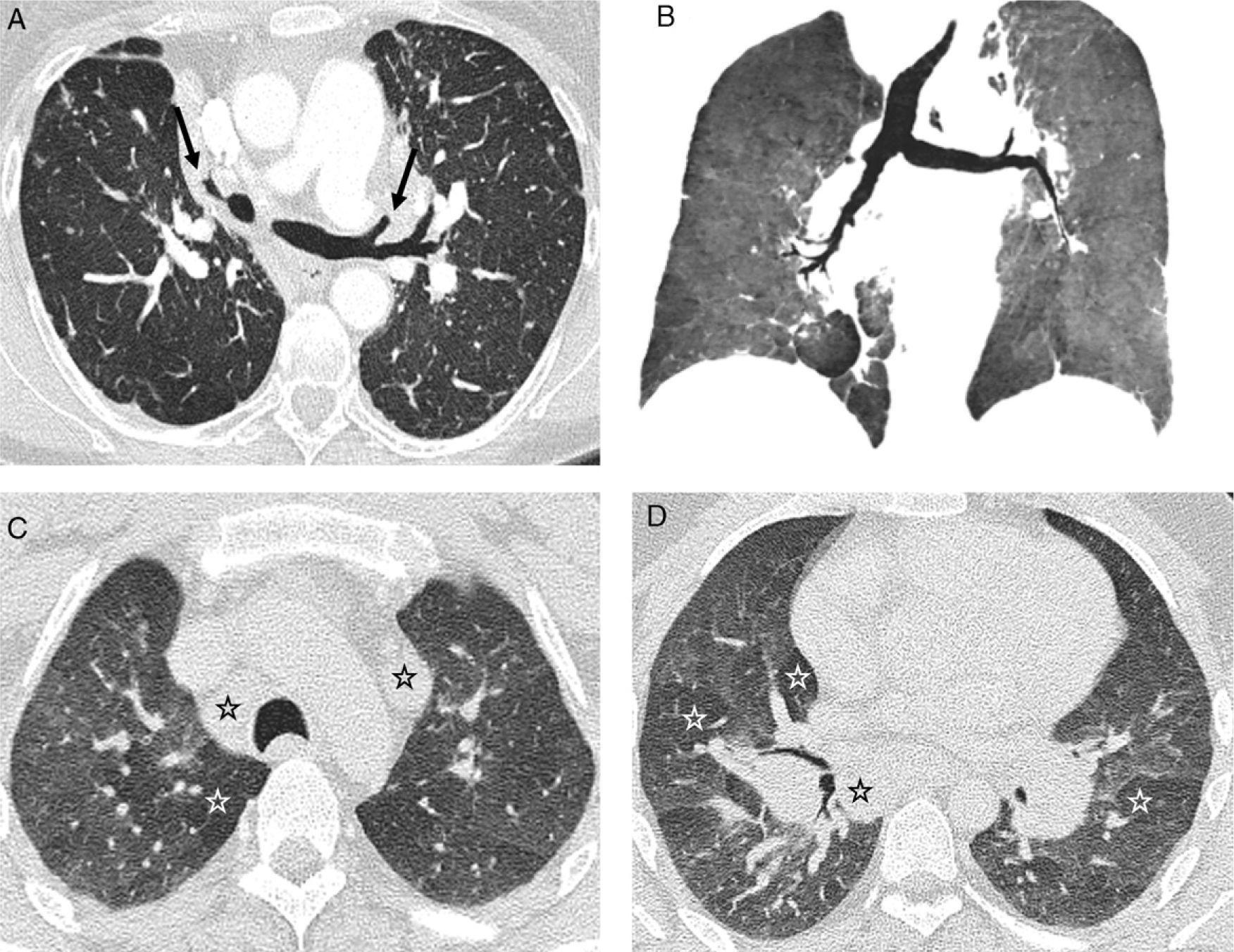 Update thoracic sarcoidosis | Radiología (English Edition)