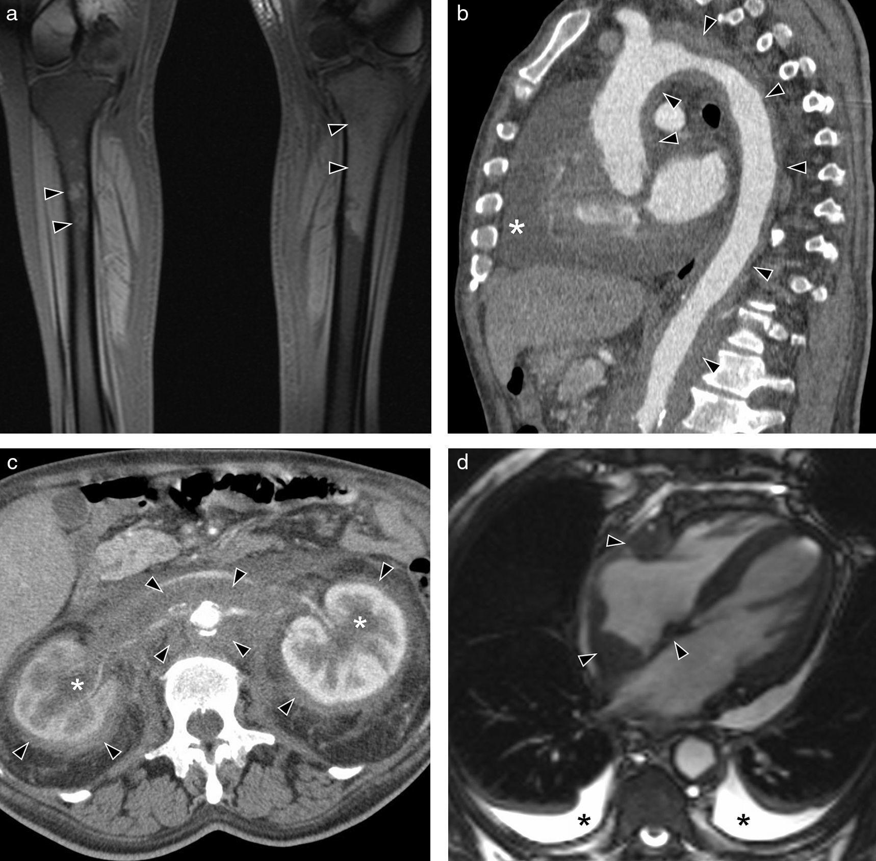Nonurgent aortic disease: Clinical-radiological diagnosis of aortitis ...