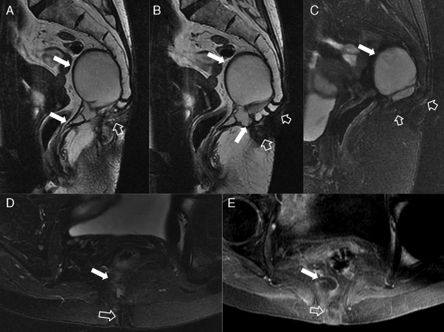 Ischiorectal Abscess Mri