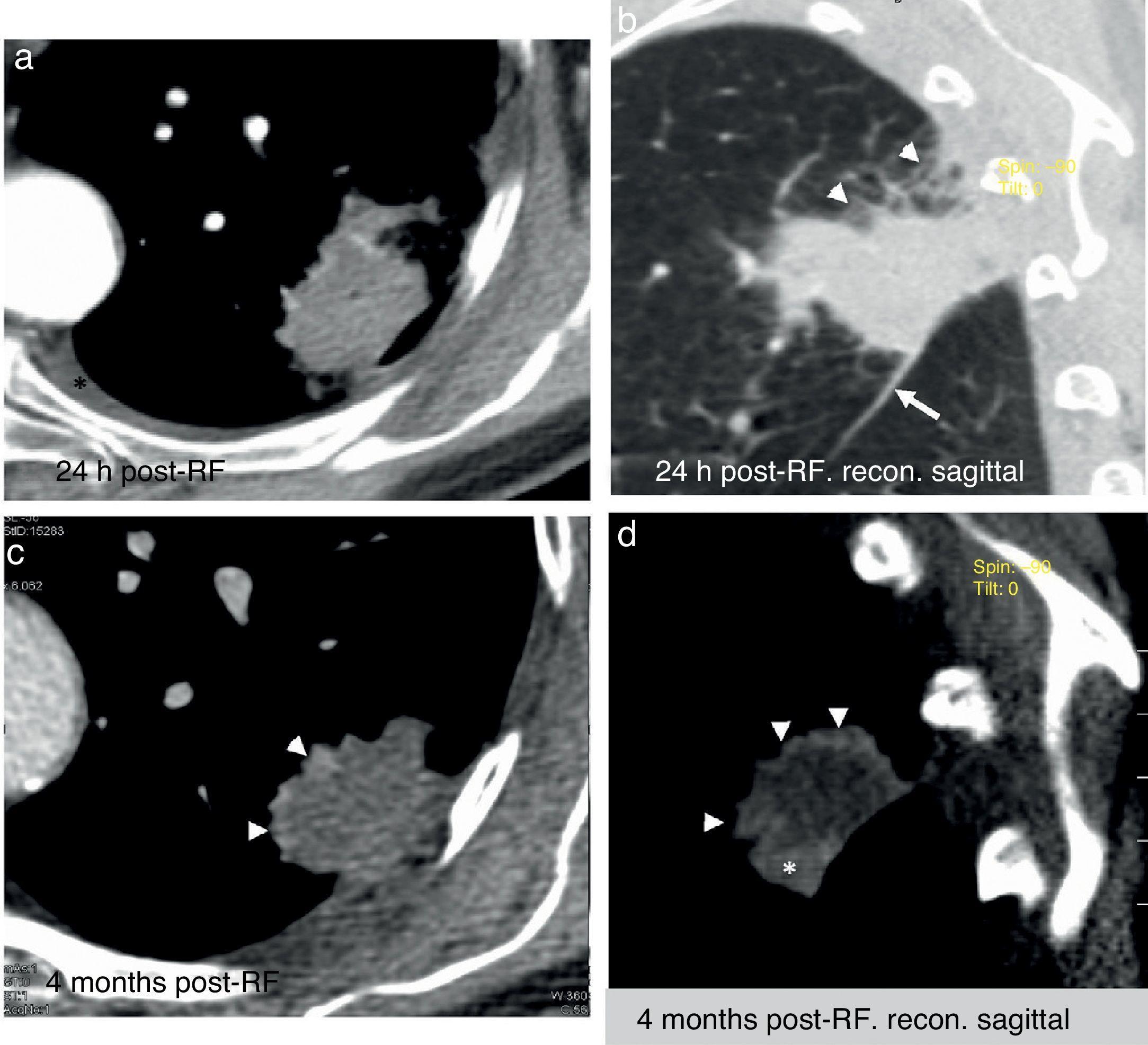 Pulmonary radiofrequency ablation (Part 1): Current state | Radiología ...