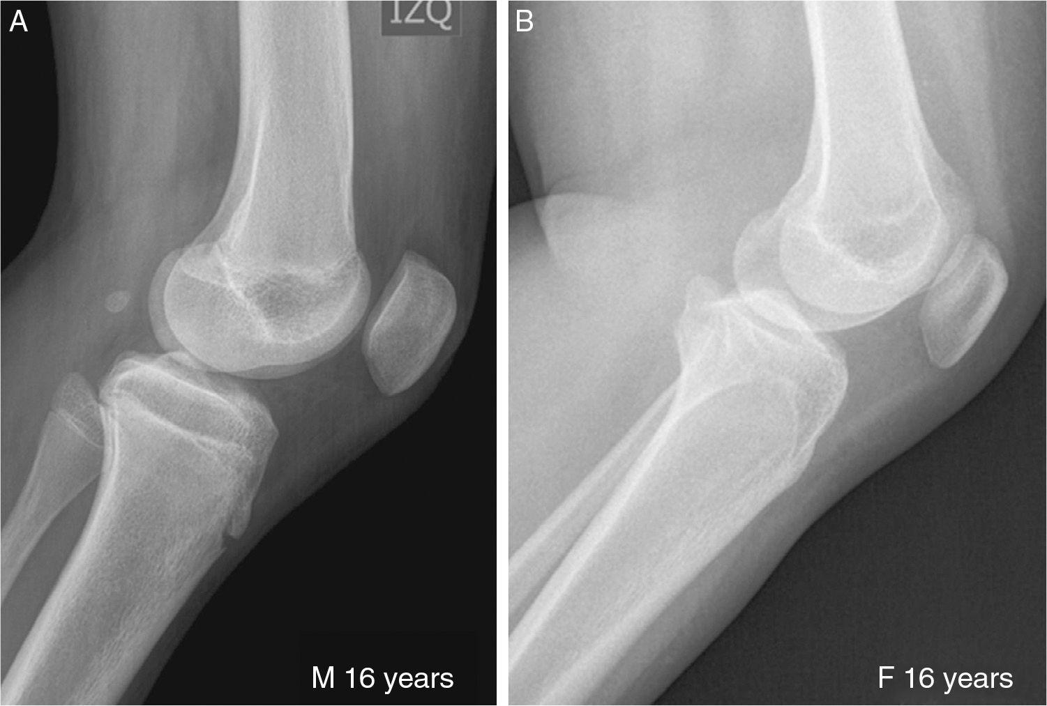 Radiographic features of the development of the anterior tibial ...