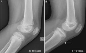 Radiographic features of the development of the anterior tibial ...