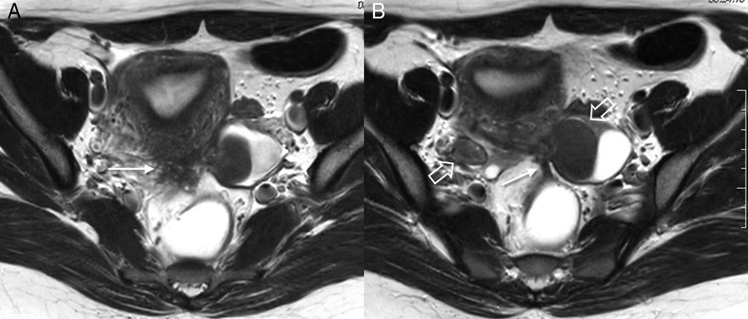 Magnetic resonance imaging of pelvic endometriosis | Radiología ...