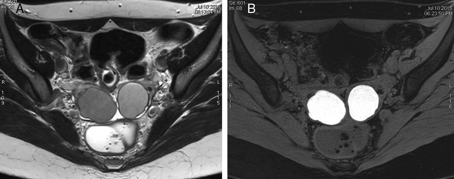 Pouch Of Douglas Mri