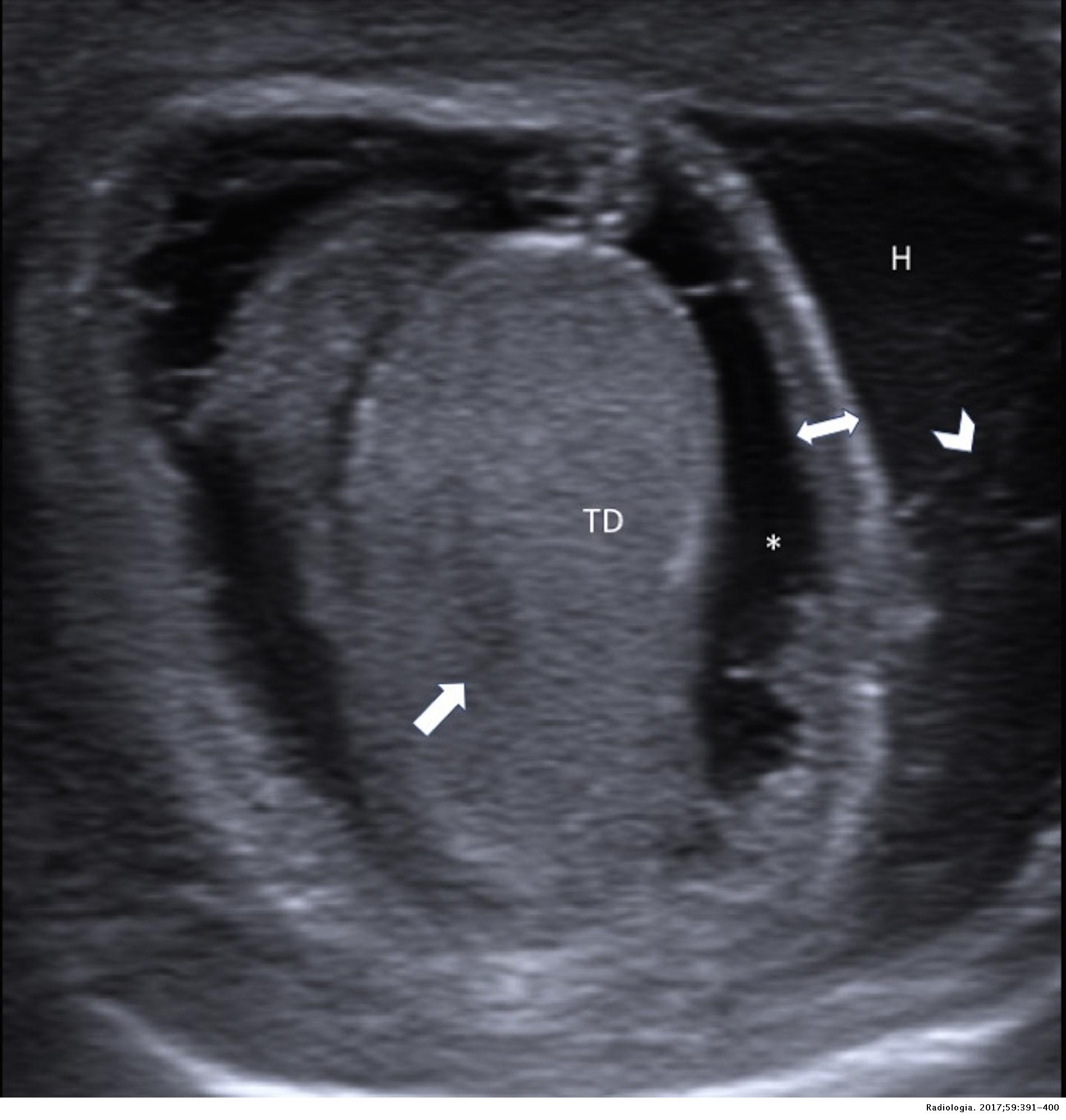 Perinatal Testicular Torsion Ultrasound Assessment And Differential