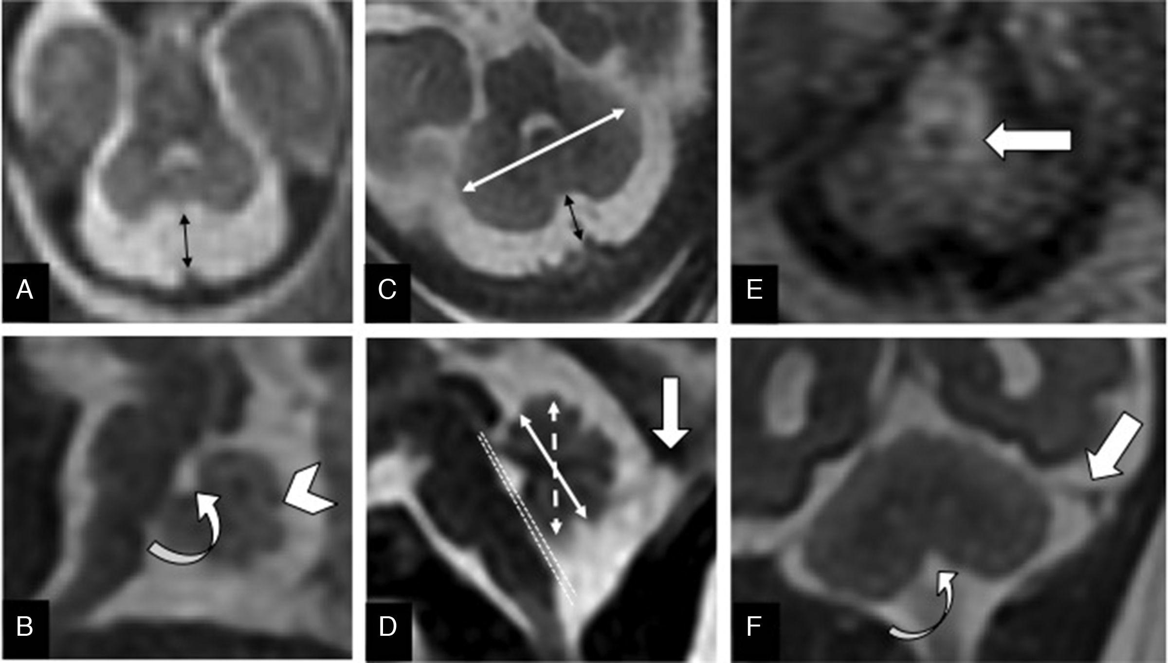 Evaluation of the fetal cerebellum by magnetic resonance imaging ...