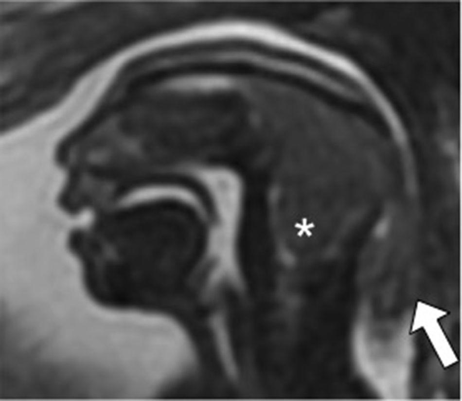 Evaluation of the fetal cerebellum by magnetic resonance imaging ...