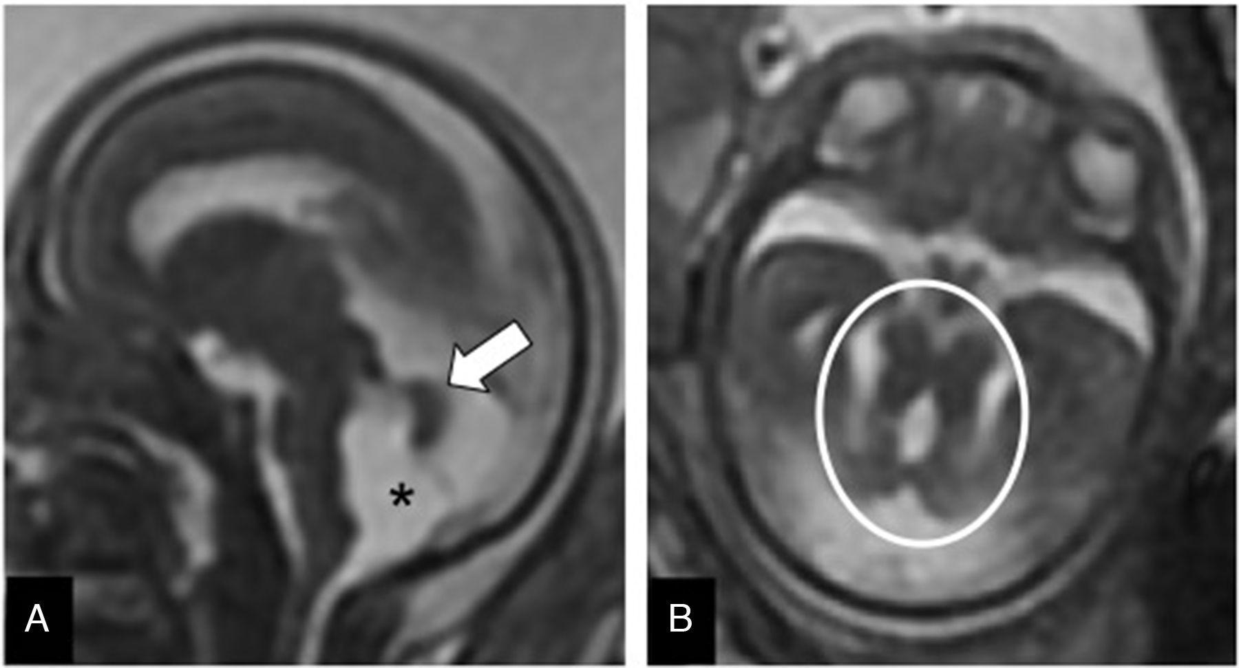 Evaluation of the fetal cerebellum by magnetic resonance imaging ...