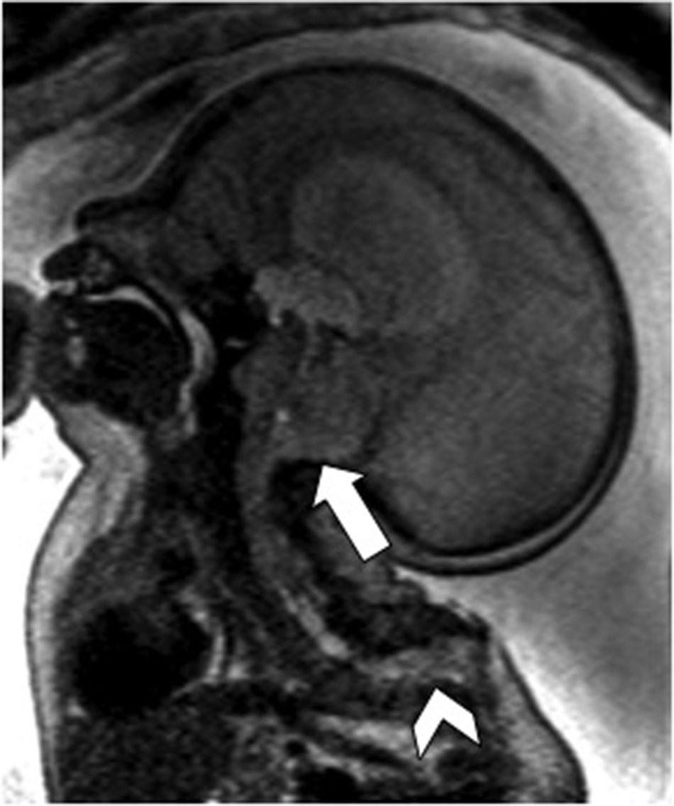 Evaluation of the fetal cerebellum by magnetic resonance imaging ...
