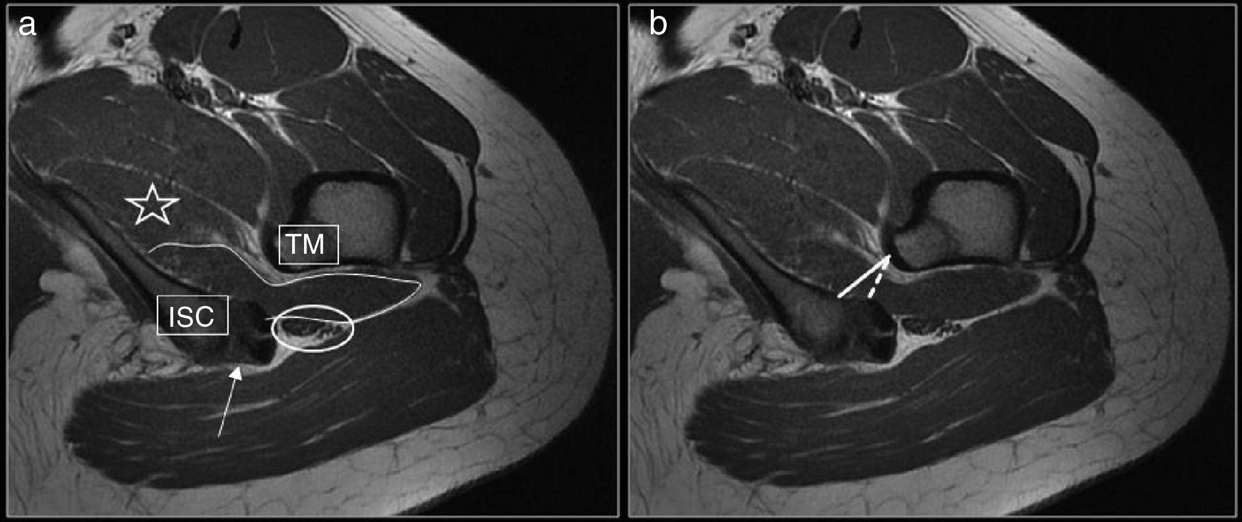 Extra-articular hip impingement: A review of the literature ...