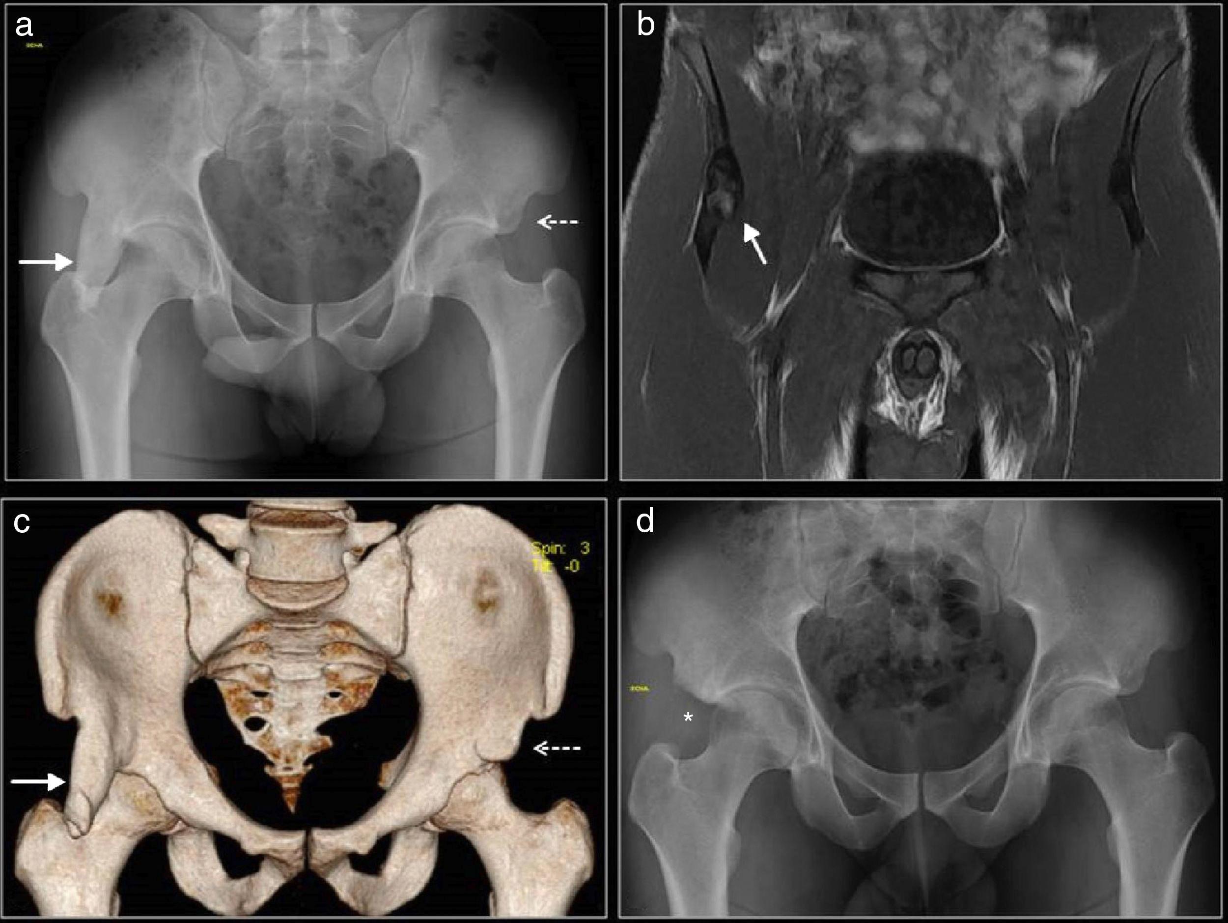 Extra-articular hip impingement: A review of the literature ...