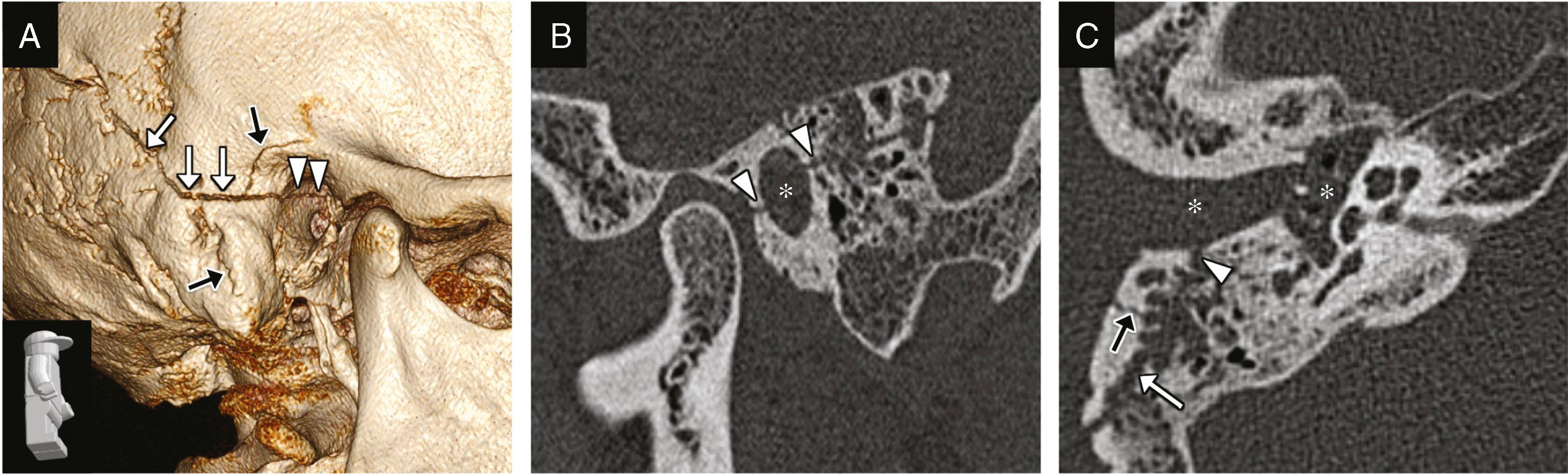 Imaging of post-traumatic hearing loss | Radiología (English Edition)