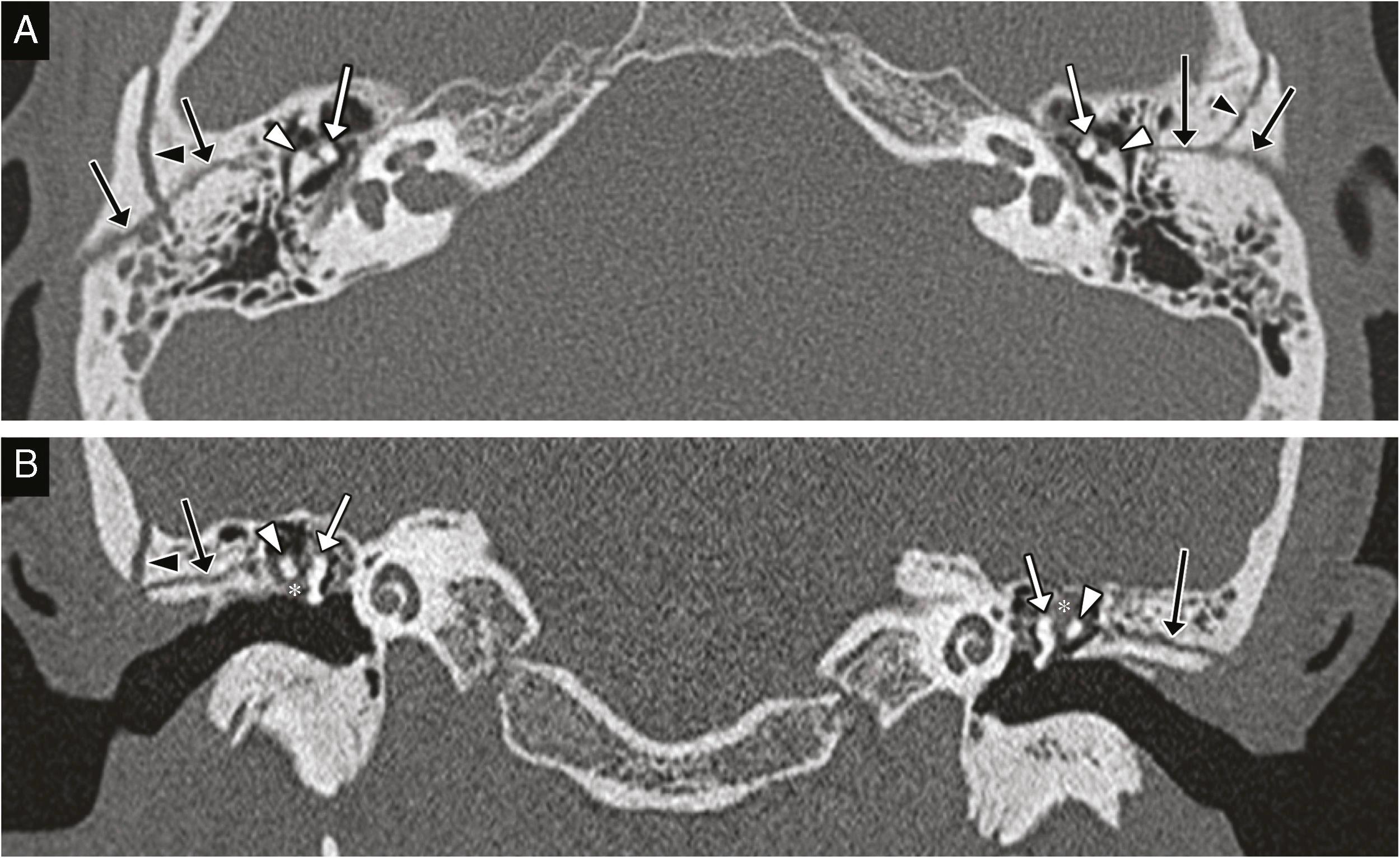 Imaging of post-traumatic hearing loss | Radiología (English Edition)