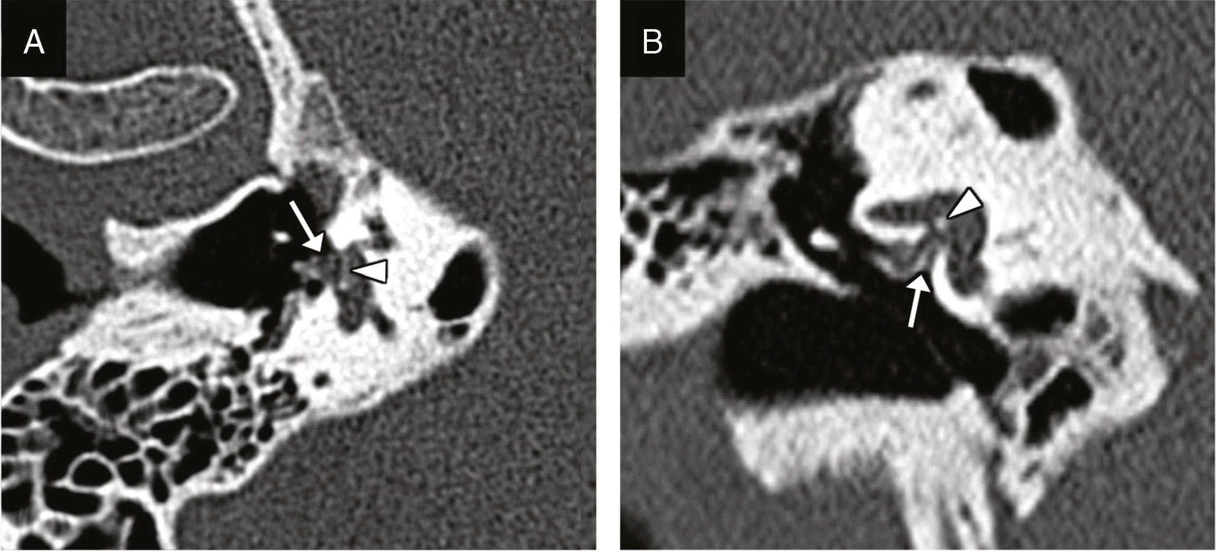 Imaging of post-traumatic hearing loss | Radiología (English Edition)