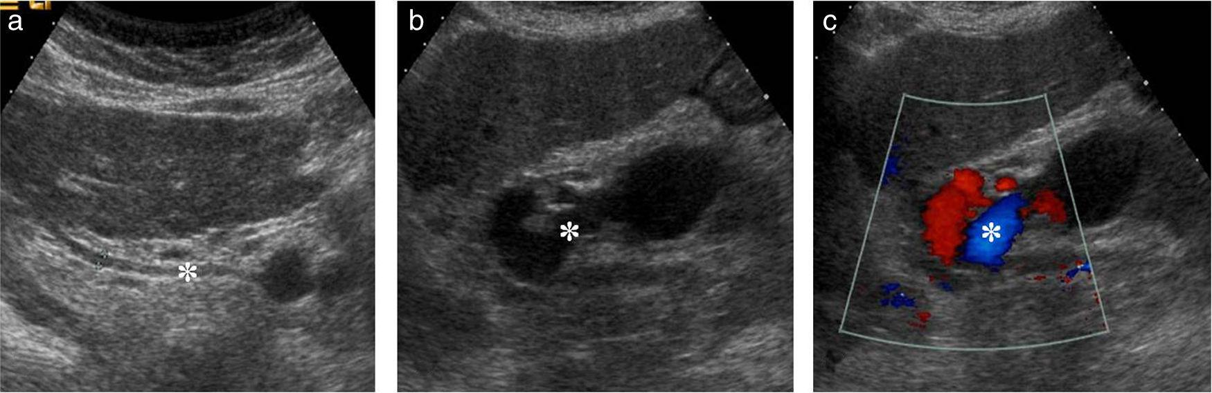 Imaging diagnosis of portal hypertension | Radiología (English Edition)