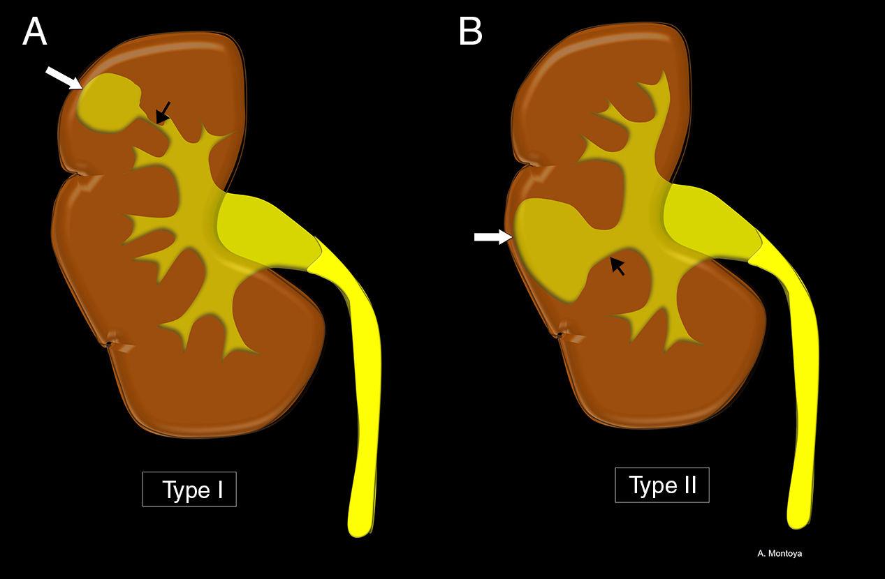 Calyceal diverticula in children: Imaging findings and presentations ...