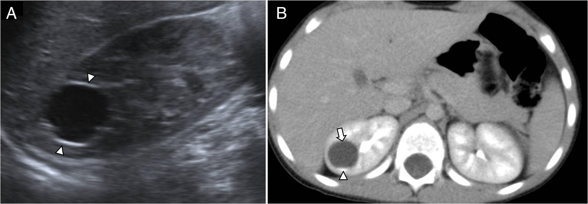 Calyceal diverticula in children: Imaging findings and presentations ...