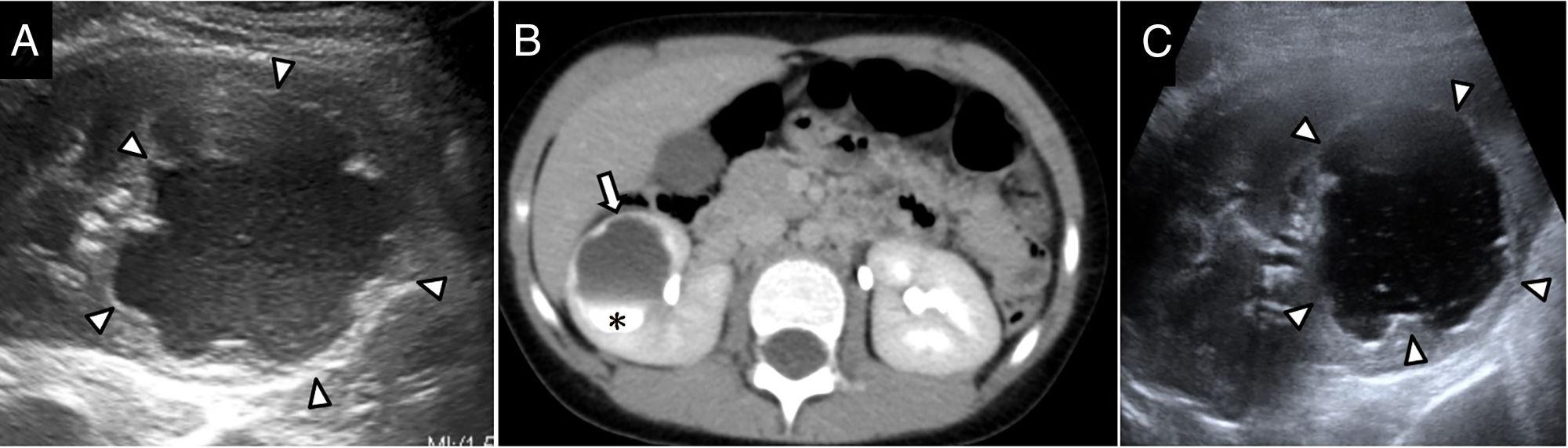 Calyceal diverticula in children: Imaging findings and presentations ...