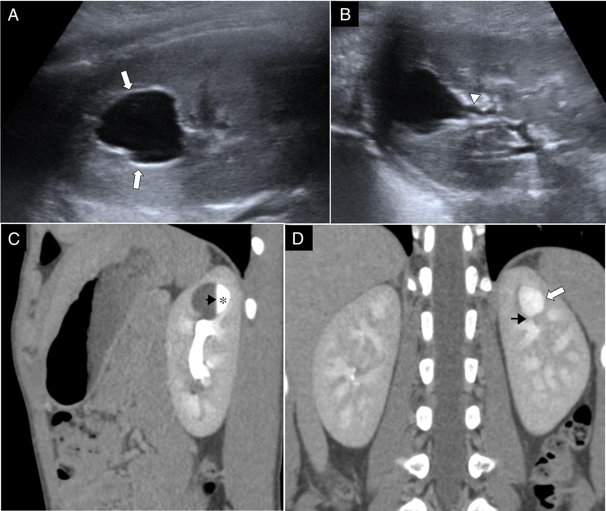 Calyceal diverticula in children: Imaging findings and presentations ...