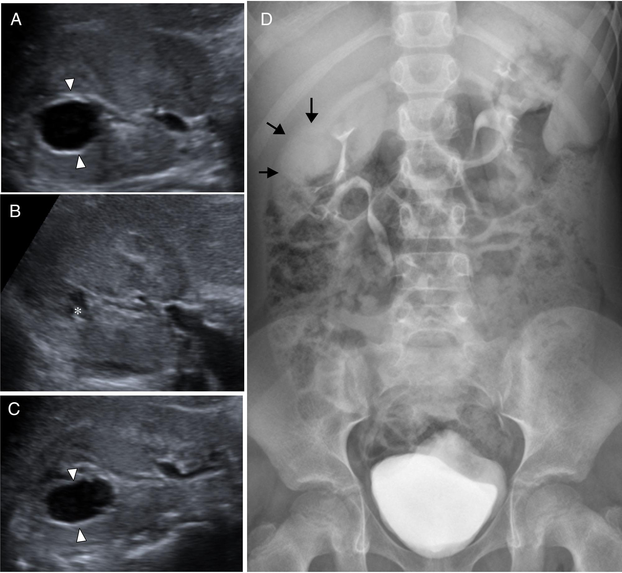Calyceal diverticula in children: Imaging findings and presentations ...
