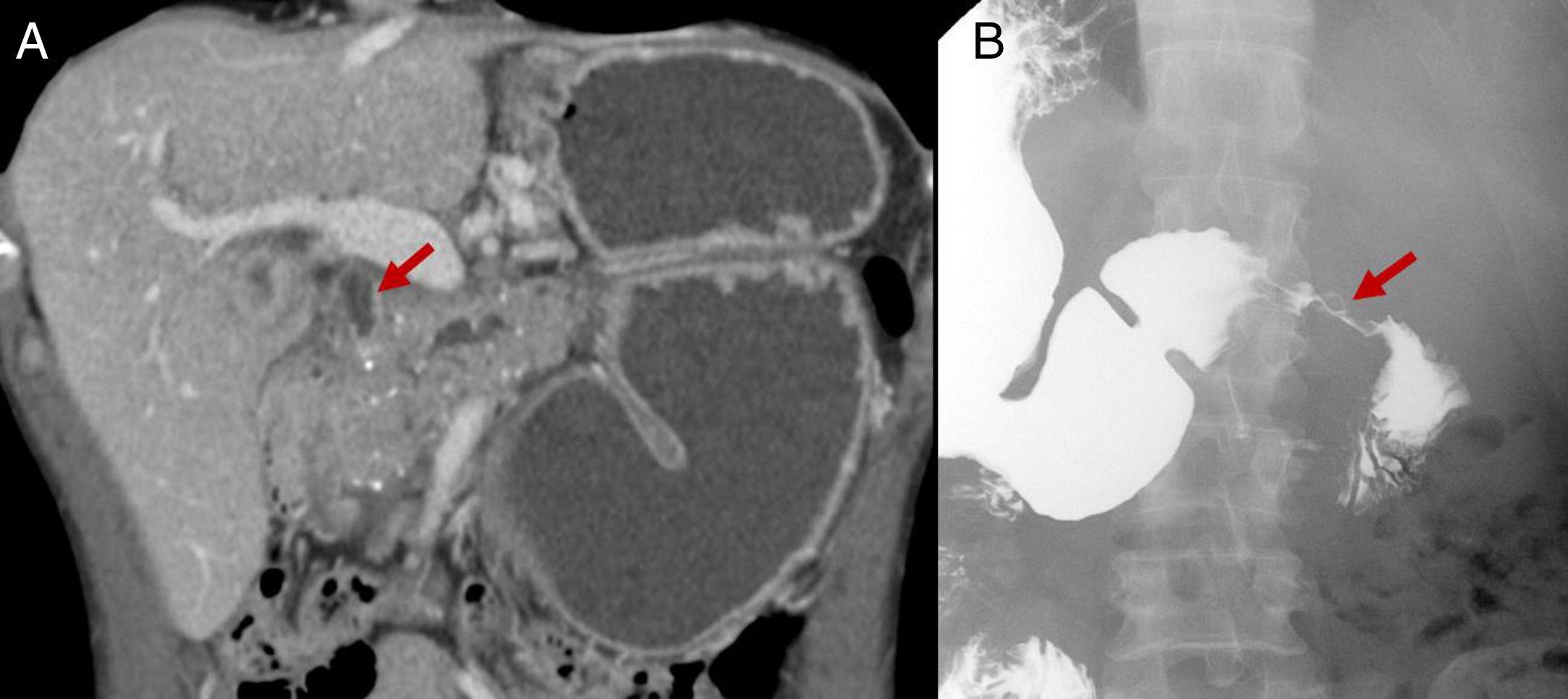 Role of imaging in the diagnosis of chronic pancreatitis | Radiología ...