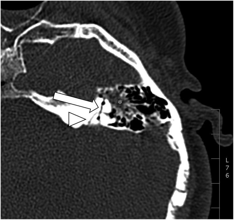 Traumatic injury of the petrous part of the temporal bone: Keys for ...