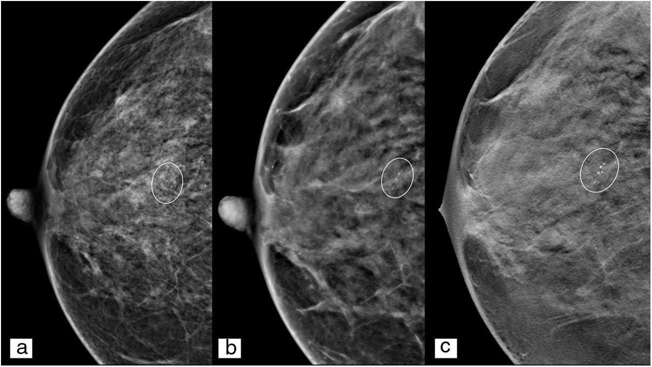Breast tomosynthesis: State of the art | Radiología (English Edition)