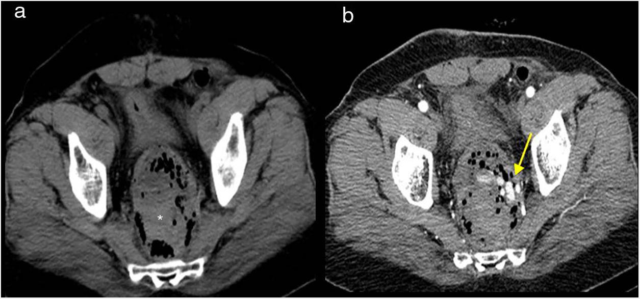Urgent multidetector computed tomography in colon cancer: Postsurgical ...