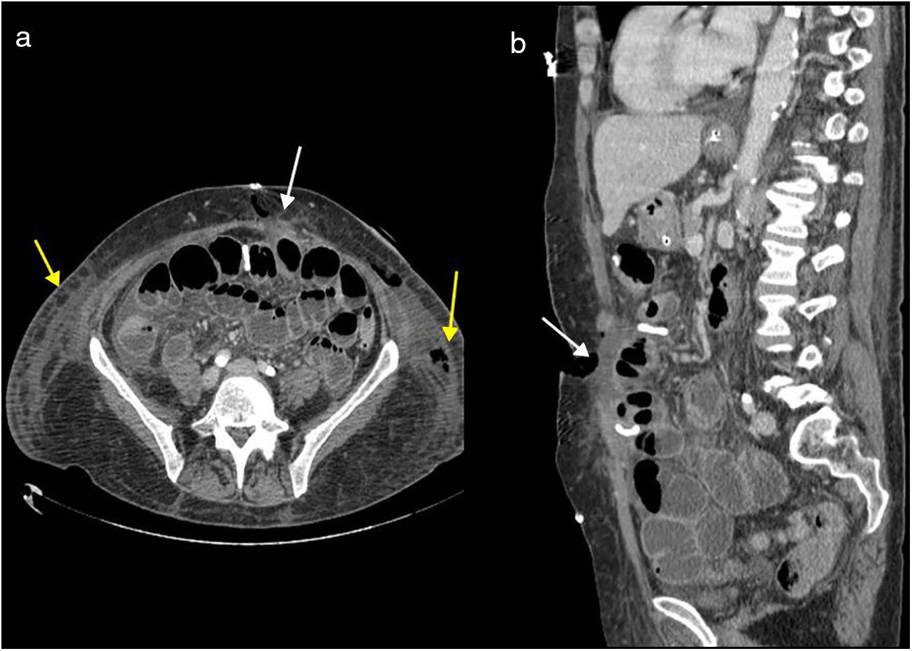 Urgent multidetector computed tomography in colon cancer: Postsurgical ...