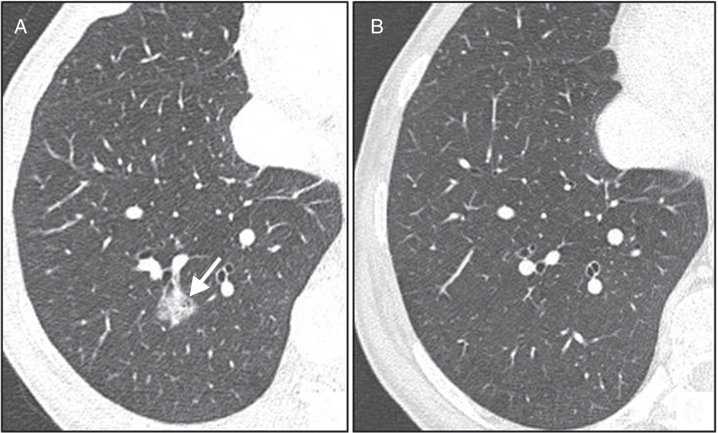 Incidental pulmonary nodules: Characterization and management ...